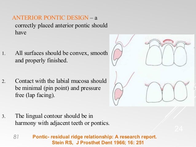 Pontics in Fixed Partial Dentures
