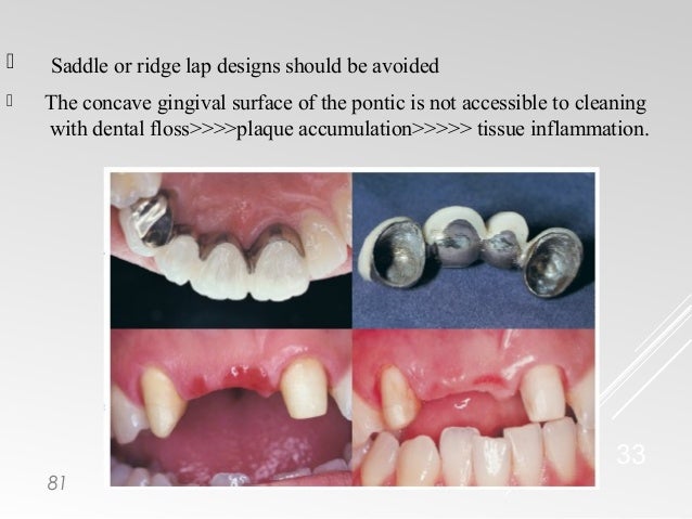 Pontics in Fixed Partial Dentures