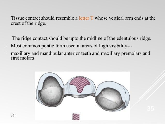 Pontics in Fixed Partial Dentures