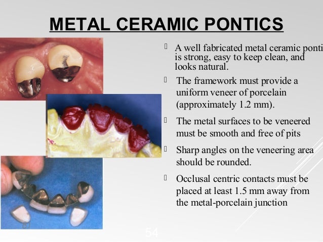 Pontics in Fixed Partial Dentures
