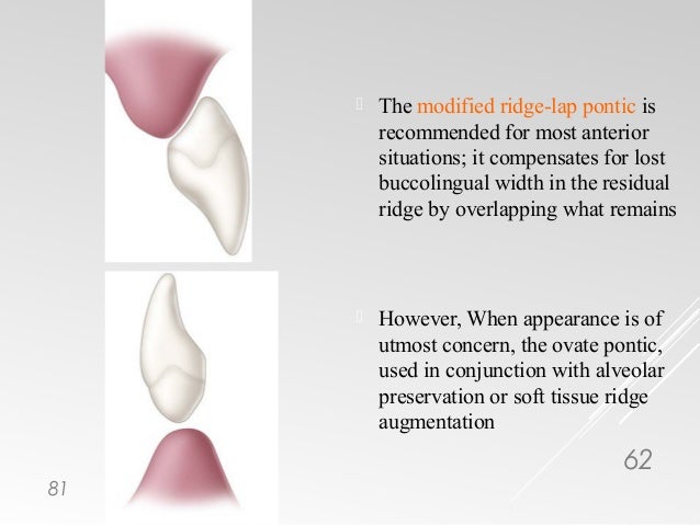 Pontics in Fixed Partial Dentures