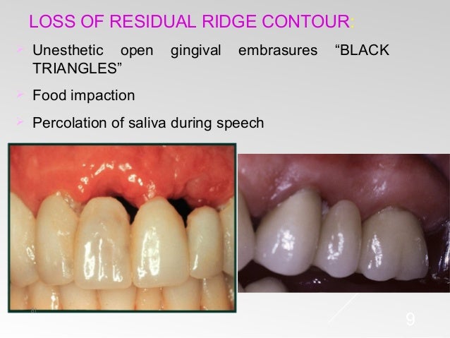 Pontics in Fixed Partial Dentures