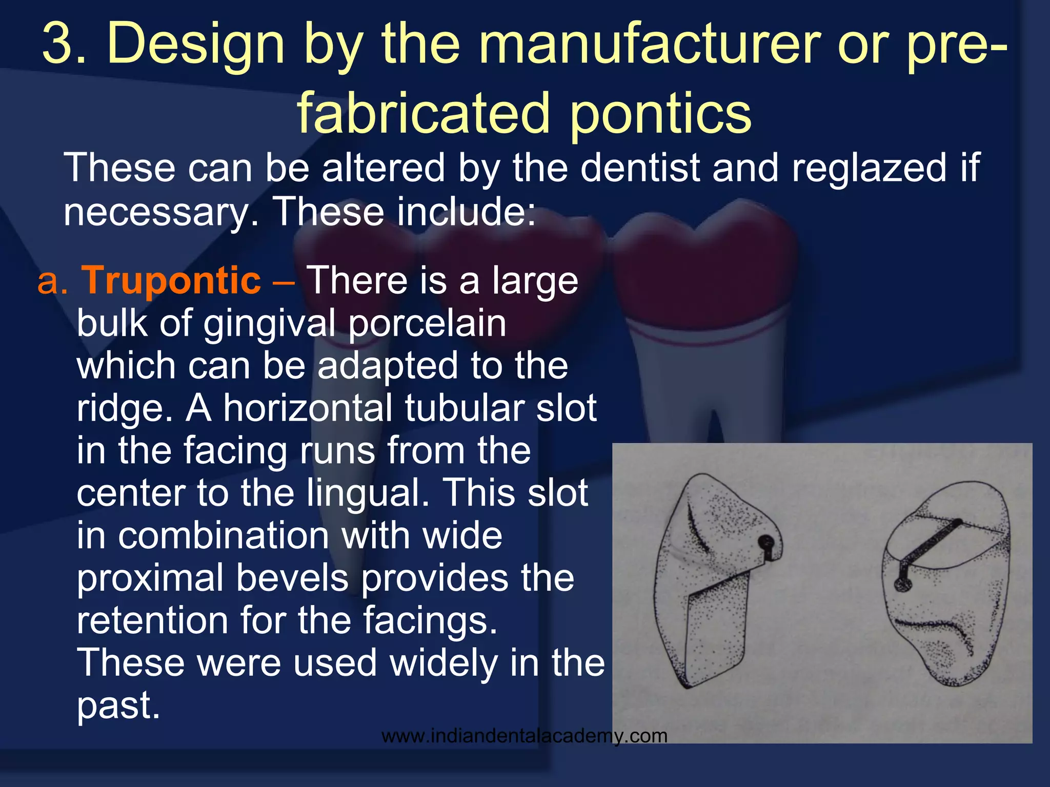 Pontics Design in fixed prosthodontics | PPT