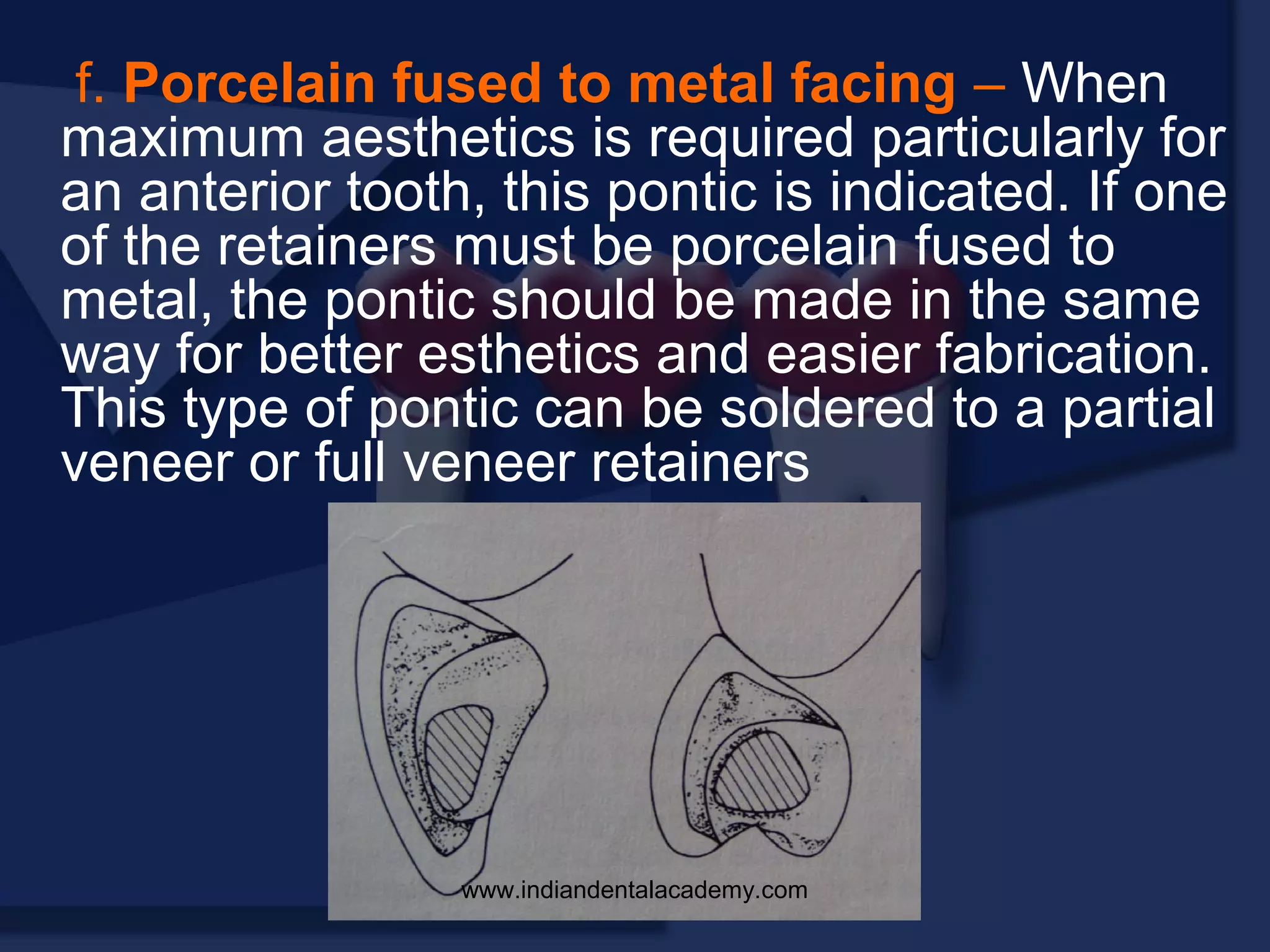 Pontics Design in fixed prosthodontics | PPT