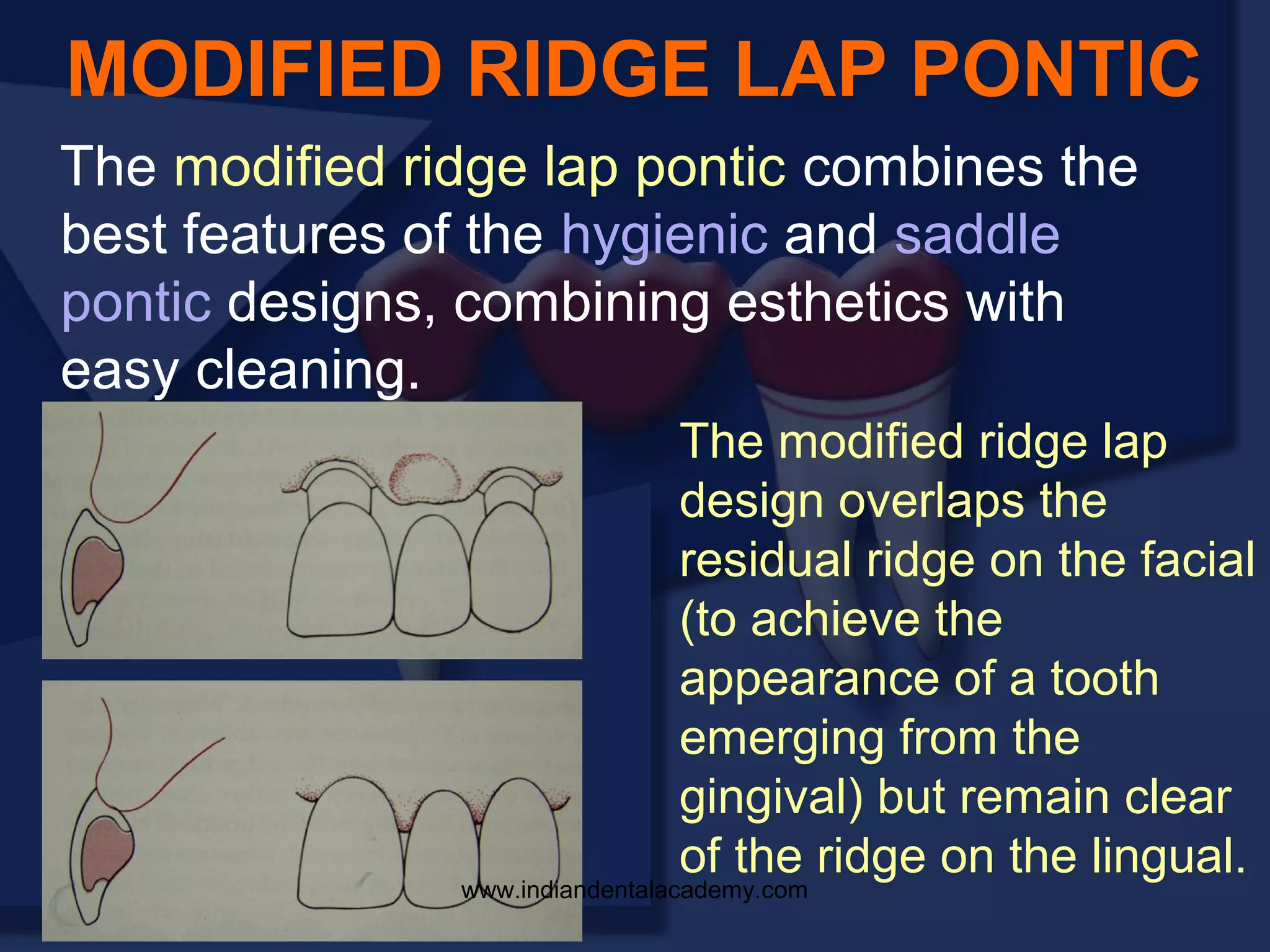 Pontics Design in fixed prosthodontics | PPT