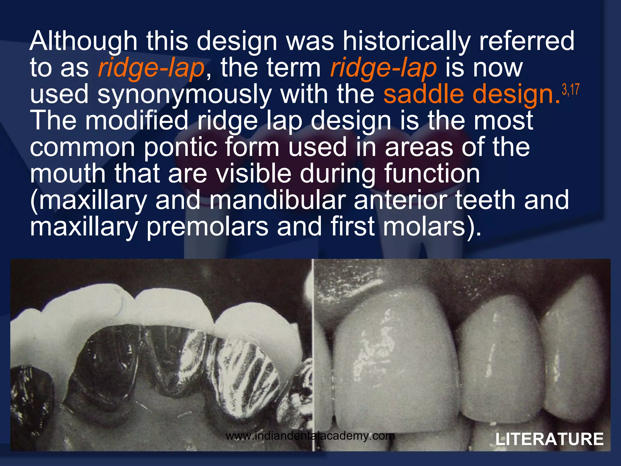 Pontics Design in fixed prosthodontics | PPT