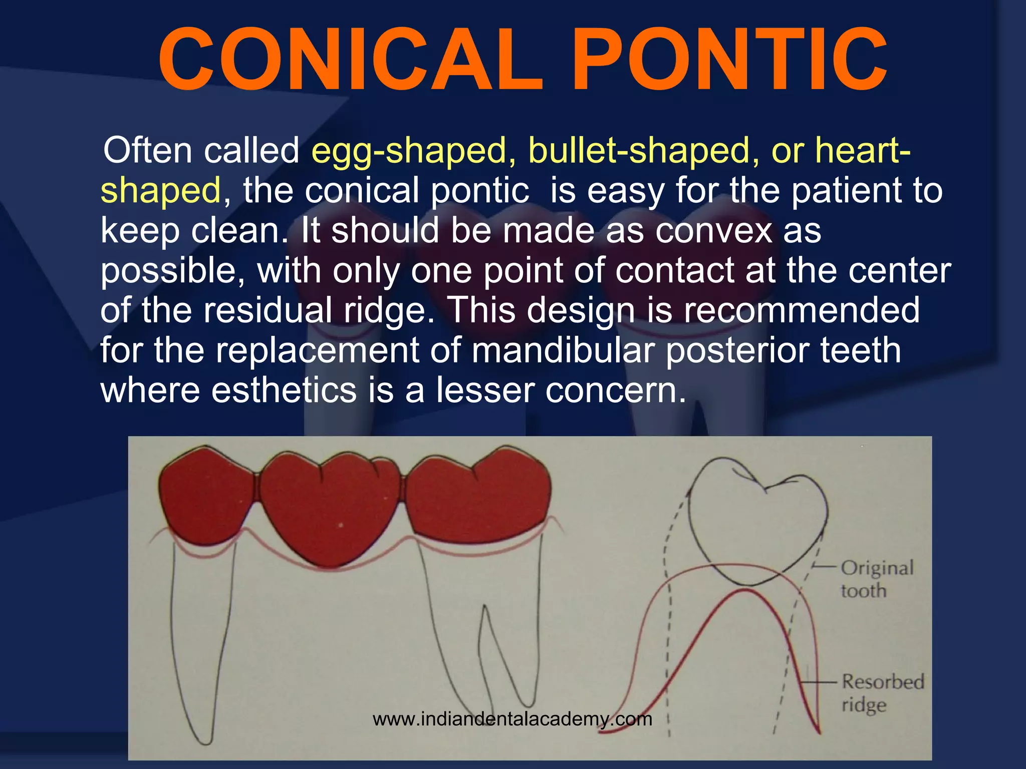Pontics Design in fixed prosthodontics | PPT