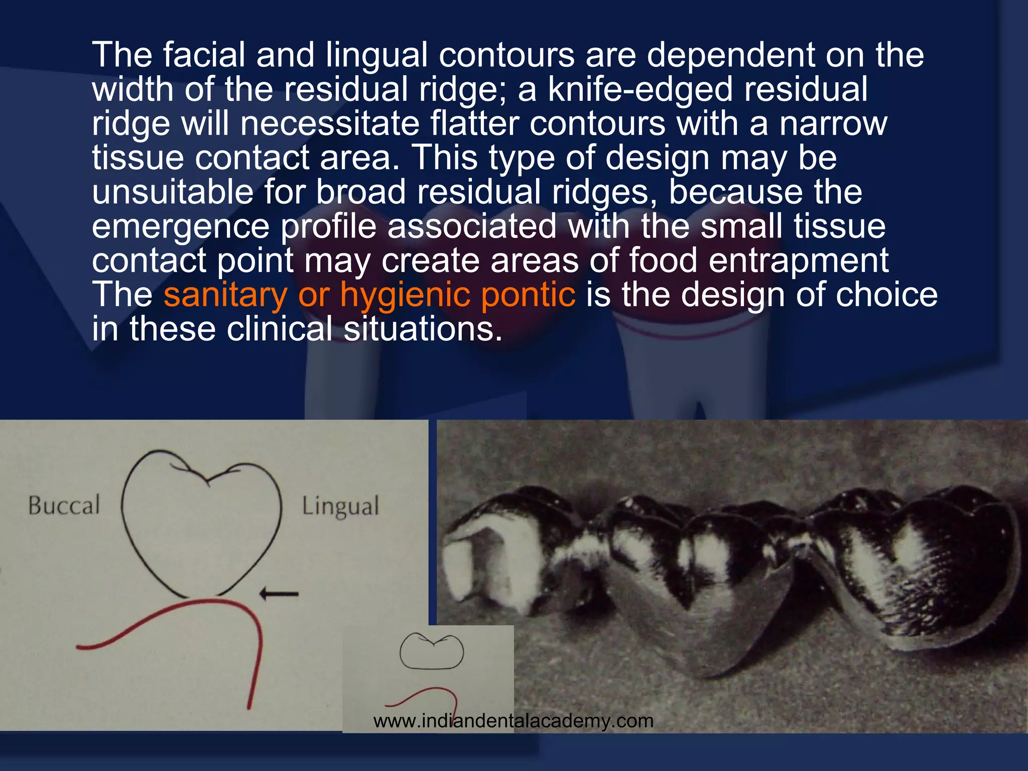 Pontics Design in fixed prosthodontics | PPT