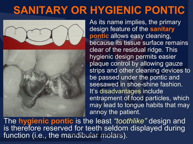 Pontics Design in fixed prosthodontics | PPT | Dental Health | Diseases ...