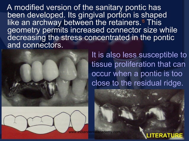 Pontics Design in fixed prosthodontics | PPT | Dental Health | Diseases ...