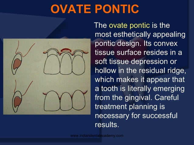 Pontics Design in fixed prosthodontics | PPT | Dental Health | Diseases ...