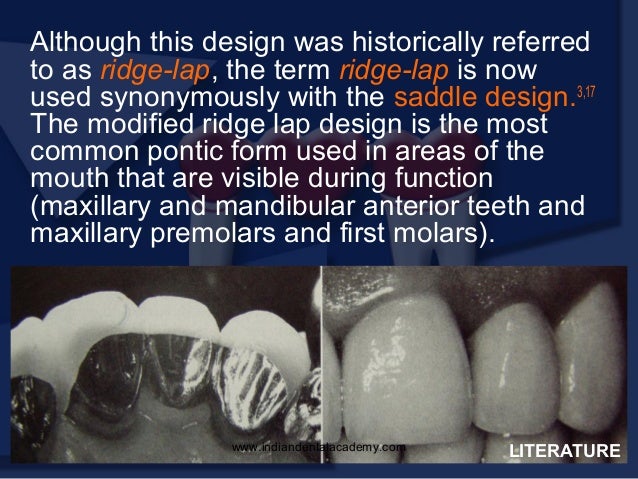 Pontics Design in fixed prosthodontics