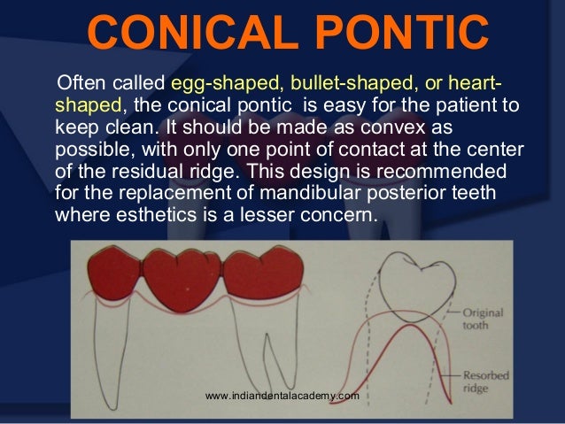 Pontics Design in fixed prosthodontics
