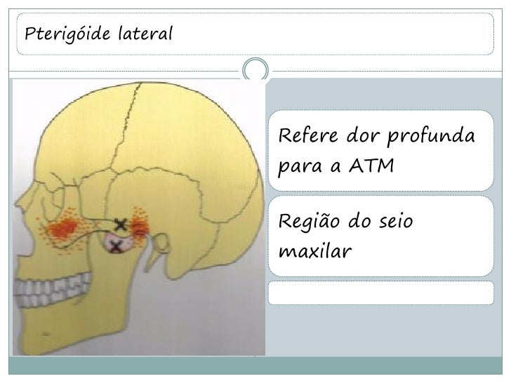 Ponto gatilho e dor referida.