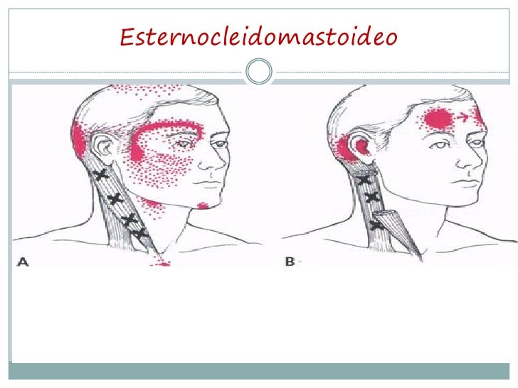 Ponto gatilho e dor referida.