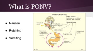 Exploration of Postoperative Nausea and Vomiting | PPTX