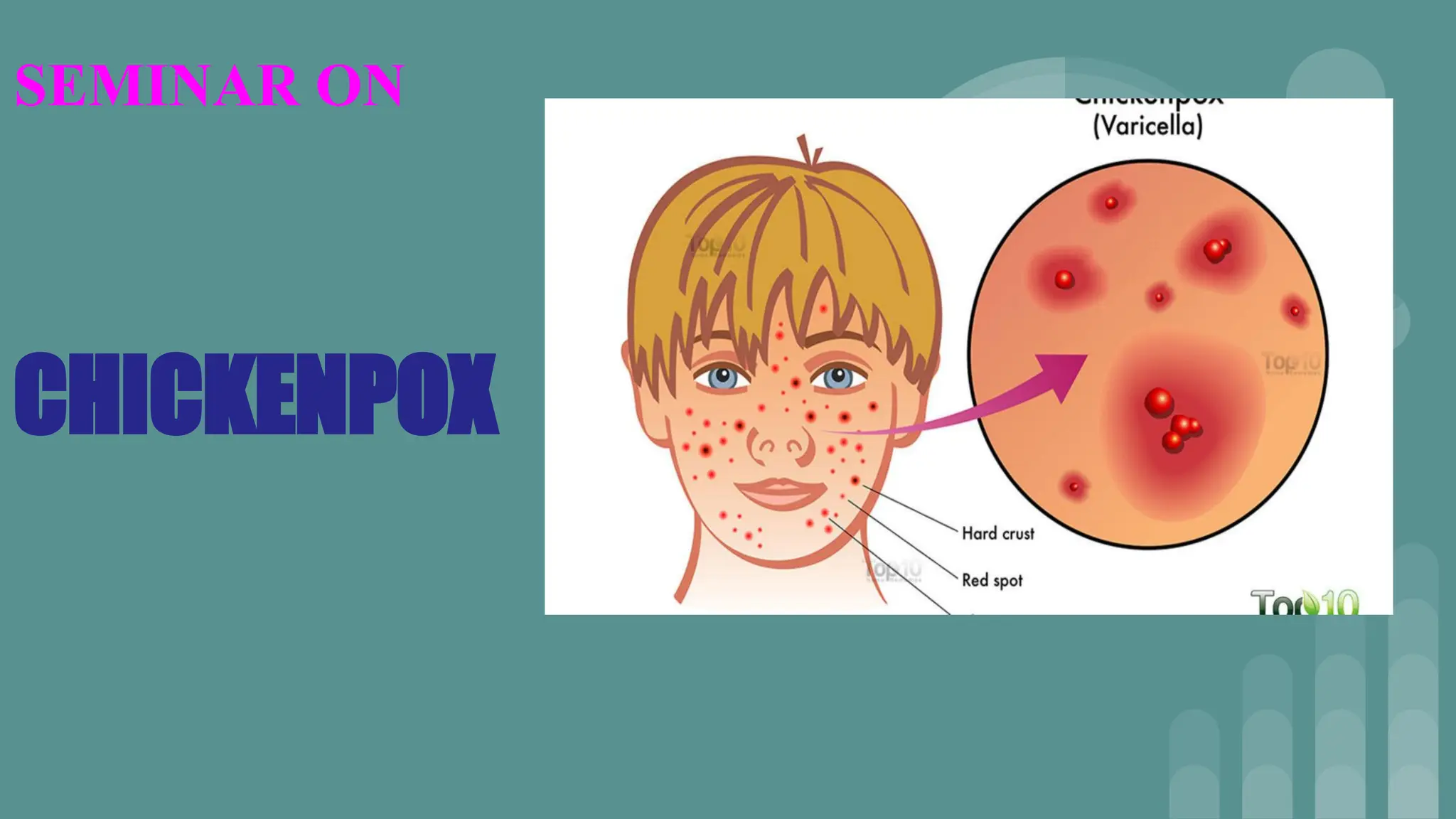 Chicken pox is a disease caused by the varicella zoster virus.it caused fever and an itchy rash..pdf