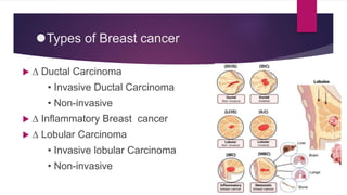 Breast cancer | PPTX