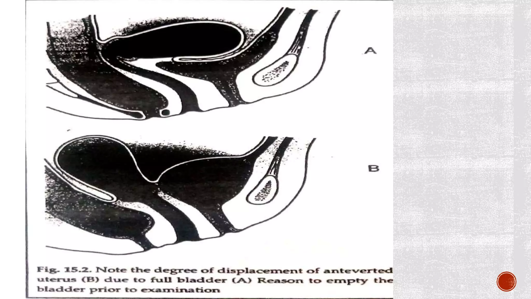 Retroverted uterus | PPTX