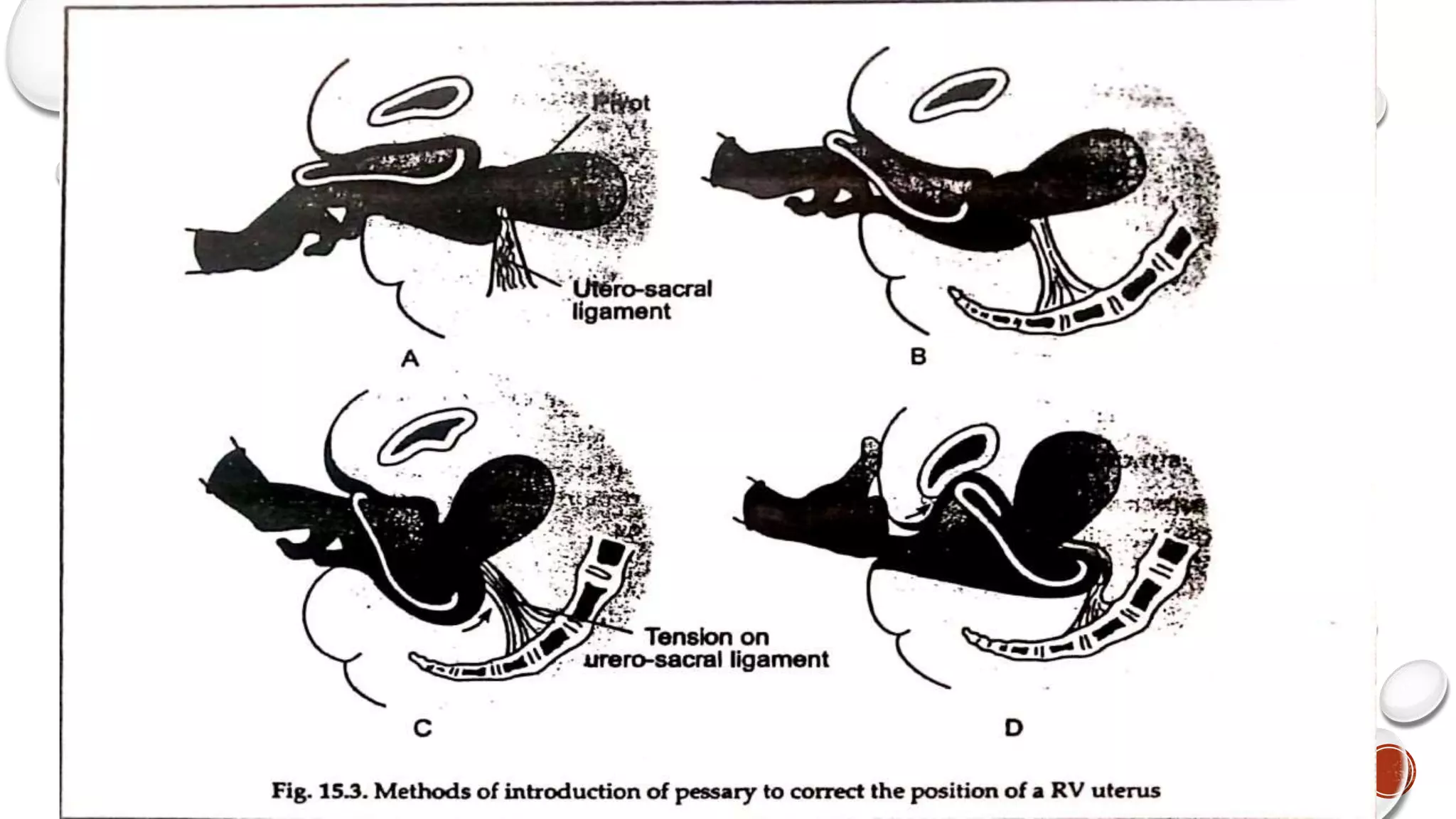Retroverted uterus | PPTX