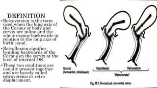 Retroverted uterus | PPTX