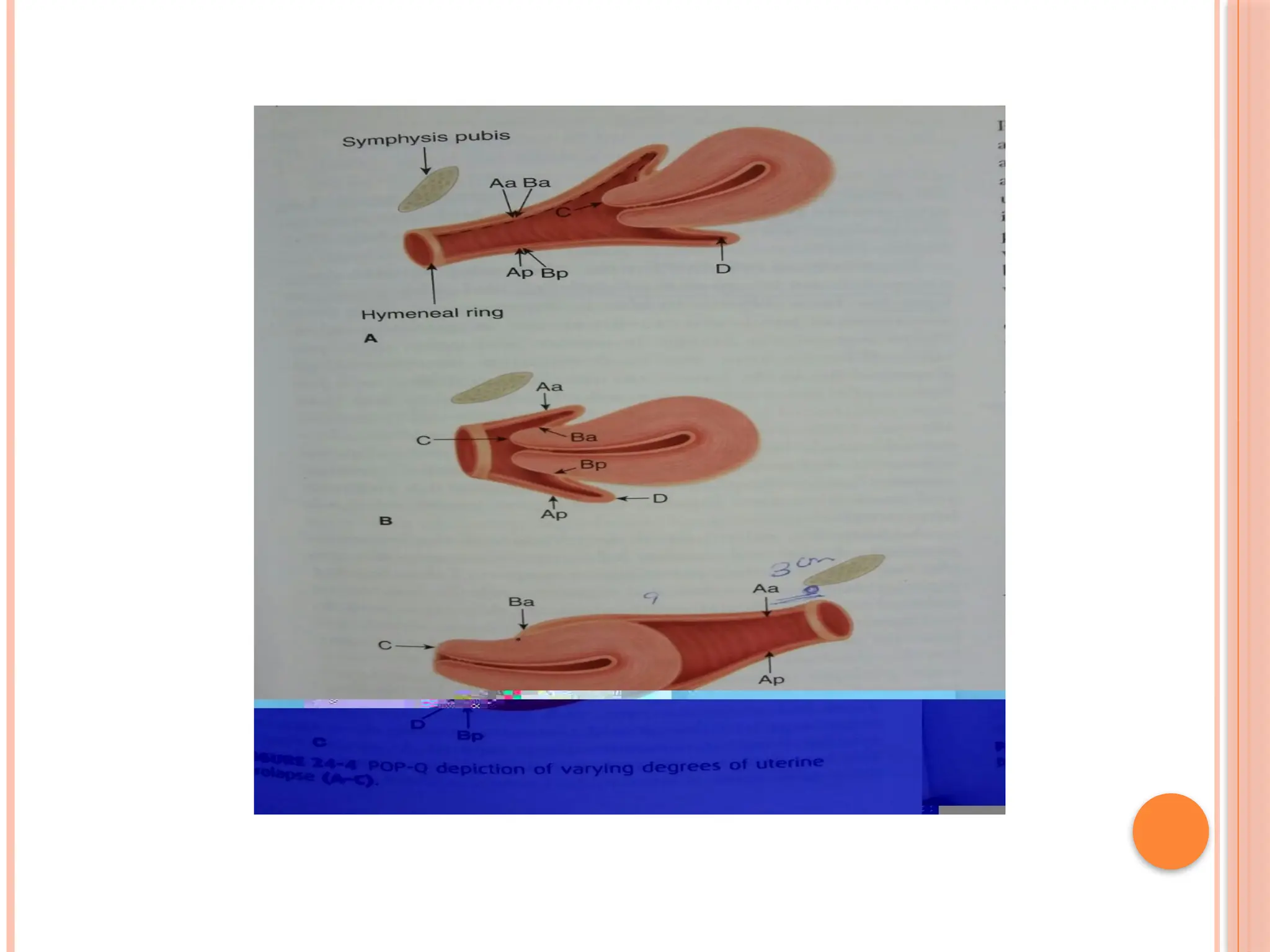 pop.pptx pelvic organ prolapse picturess | PPT