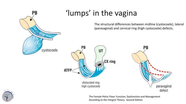 Pelvic anatomy in relation with pelvic organ prolapse | PDF