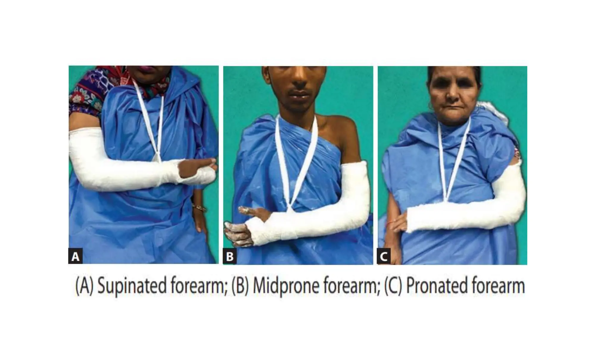 pop and bone cement orthopaedics ppt.pptx