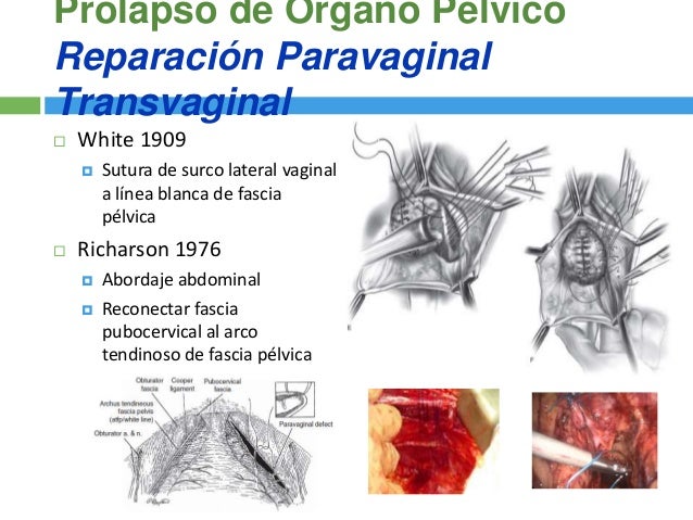 Cirugia Reconstructiva del Prolapso de Organo Pelvico