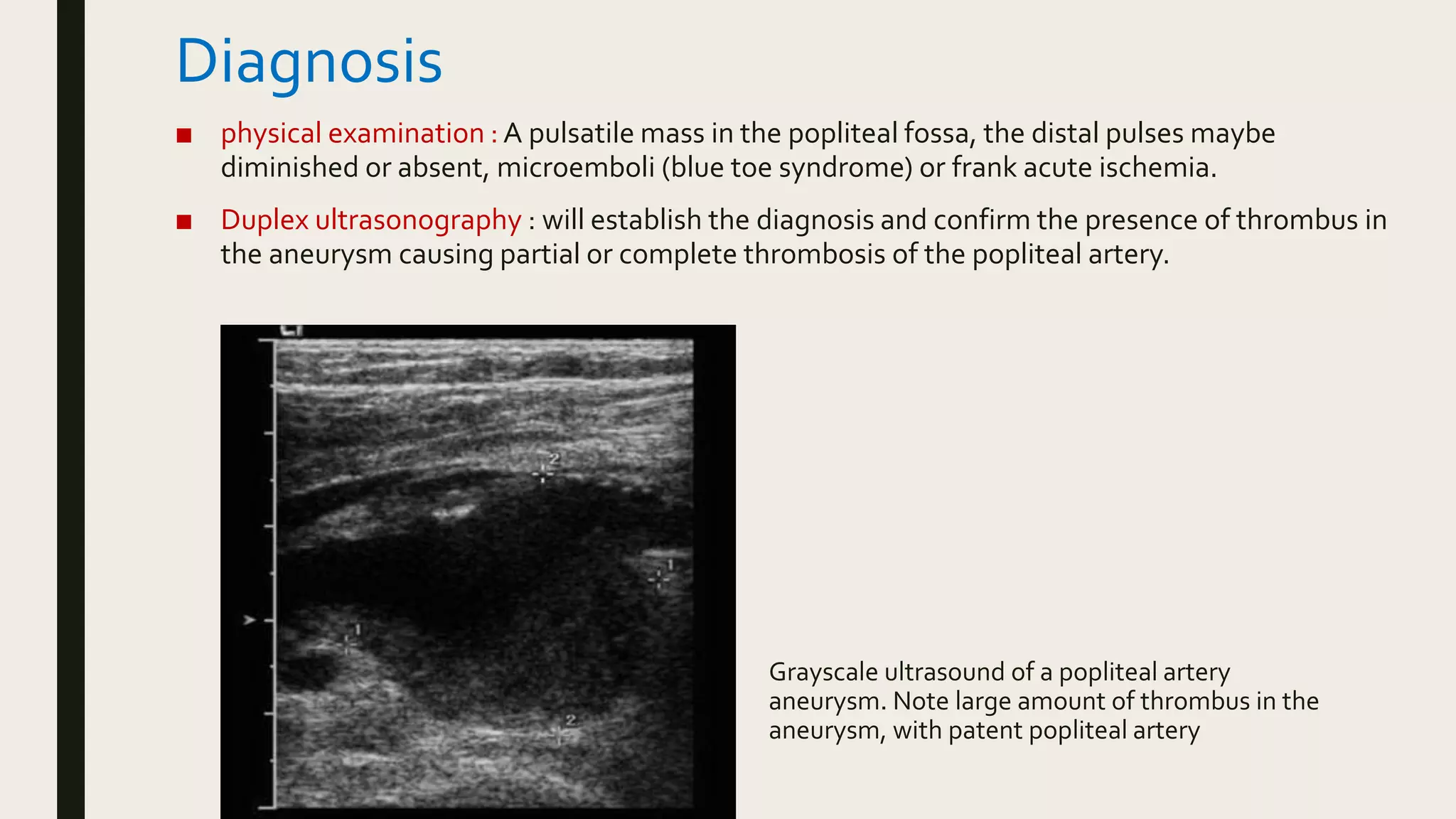 Popliteal artery aneurysm | PPTX