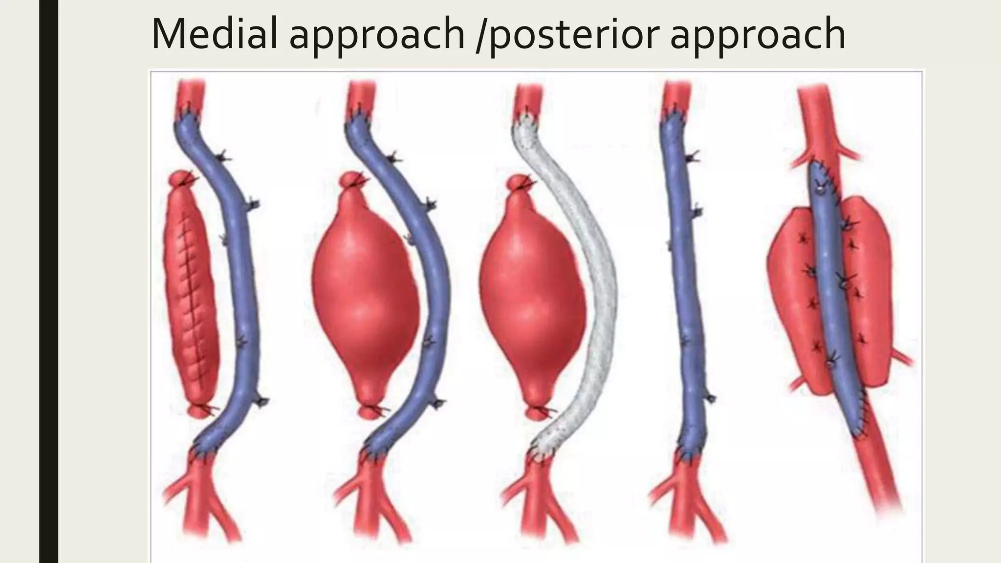 Popliteal artery aneurysm | PPTX