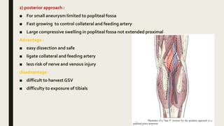 Popliteal artery aneurysm | PPTX