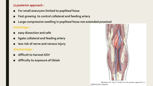 Popliteal artery aneurysm | PPTX