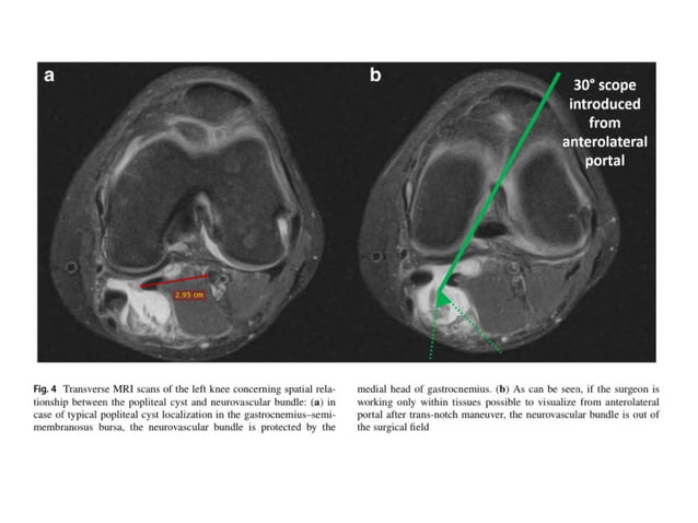 Popliteal_Cyst_Presentation in the knee.pptx