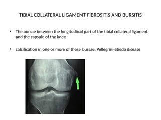 Popliteal_Cyst_Presentation in the knee.pptx