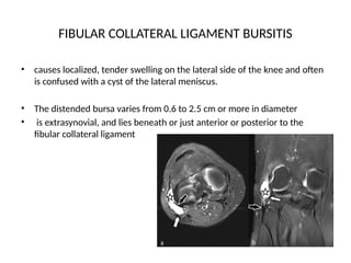 Popliteal_Cyst_Presentation in the knee.pptx