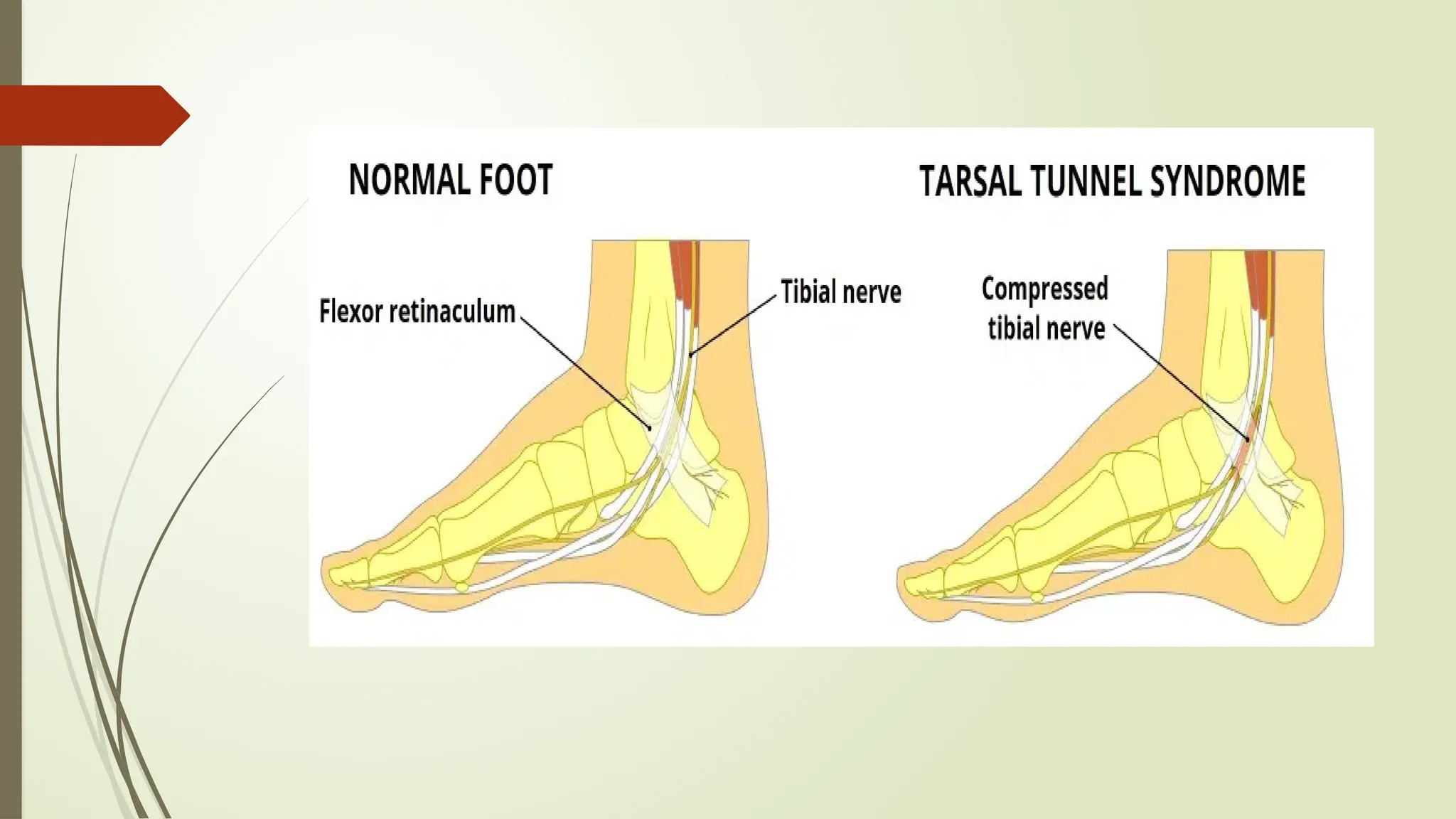 POPLITEAL FOSSA/knee fossa/ regional anatomy | PPT
