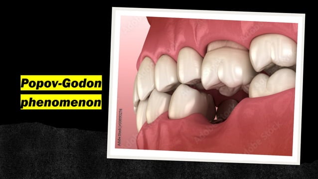 Popov-Godon phenomenon presentation for dentestry | PPTX | Dental ...