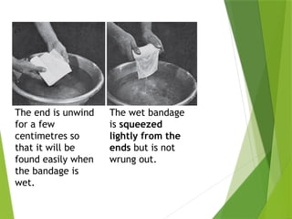 General principles of Plaster of Paris cast/slab immobilization in ...