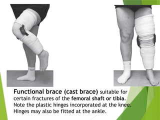 General principles of Plaster of Paris cast/slab immobilization in ...