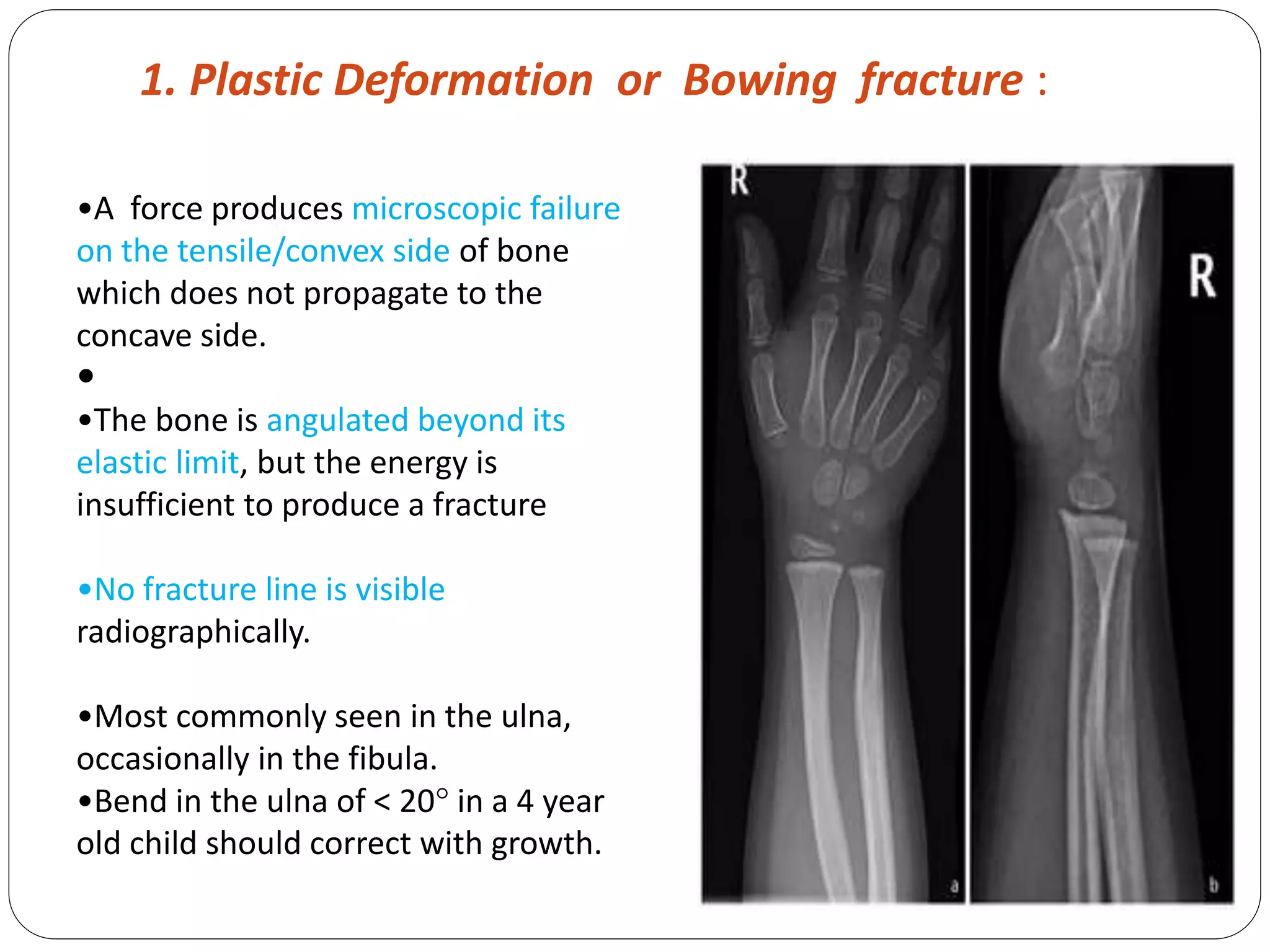 Fracture types - Plaster Of Paris tecniques and Complications | PPTX
