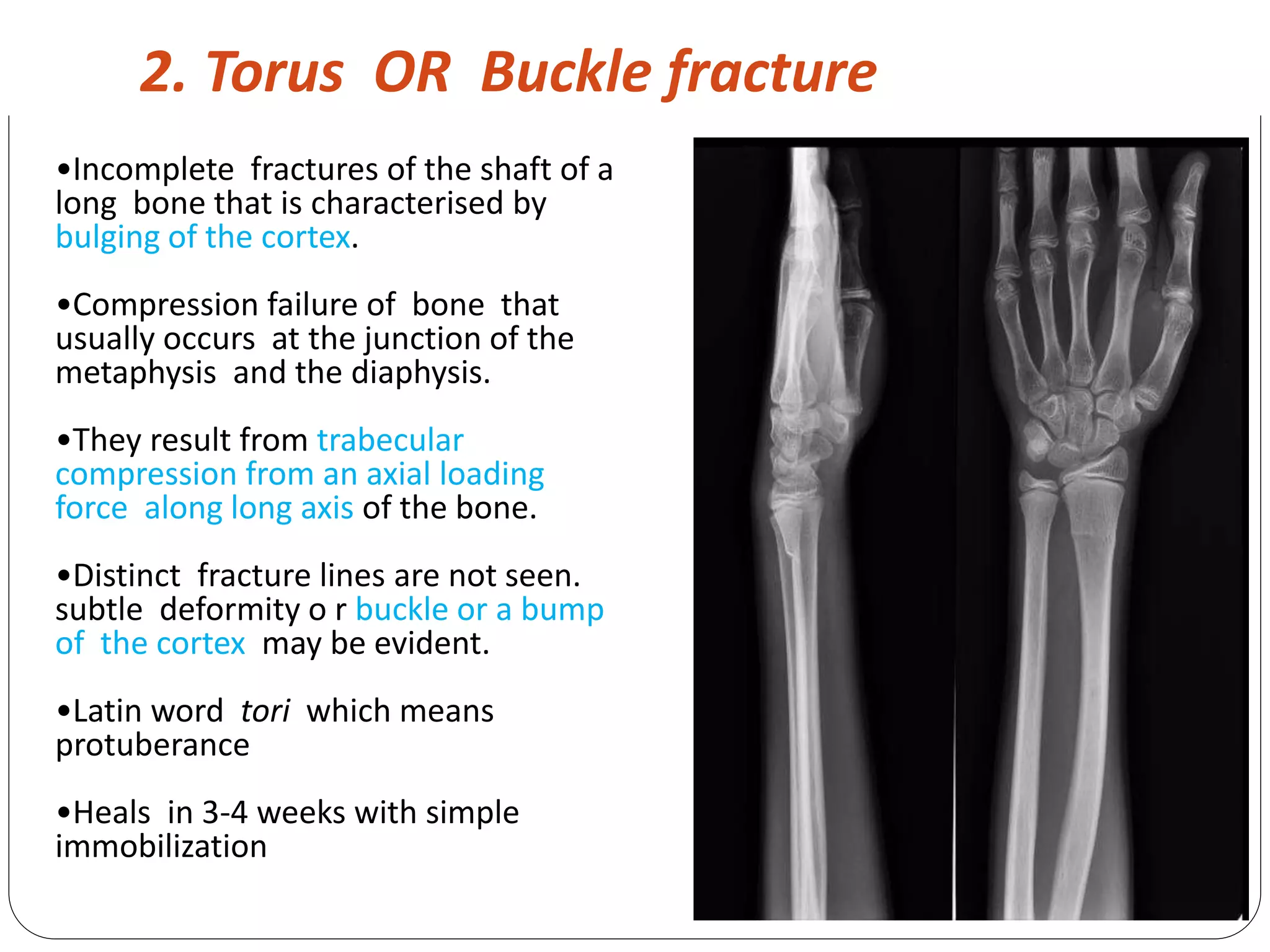Fracture types - Plaster Of Paris tecniques and Complications | PPTX