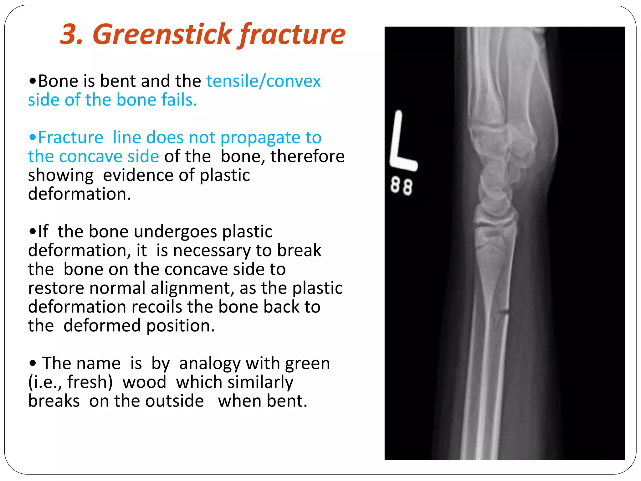 Fracture types - Plaster Of Paris tecniques and Complications | PPTX