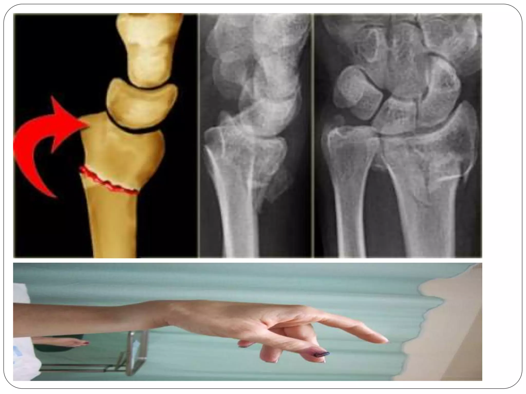 Fracture types - Plaster Of Paris tecniques and Complications | PPTX