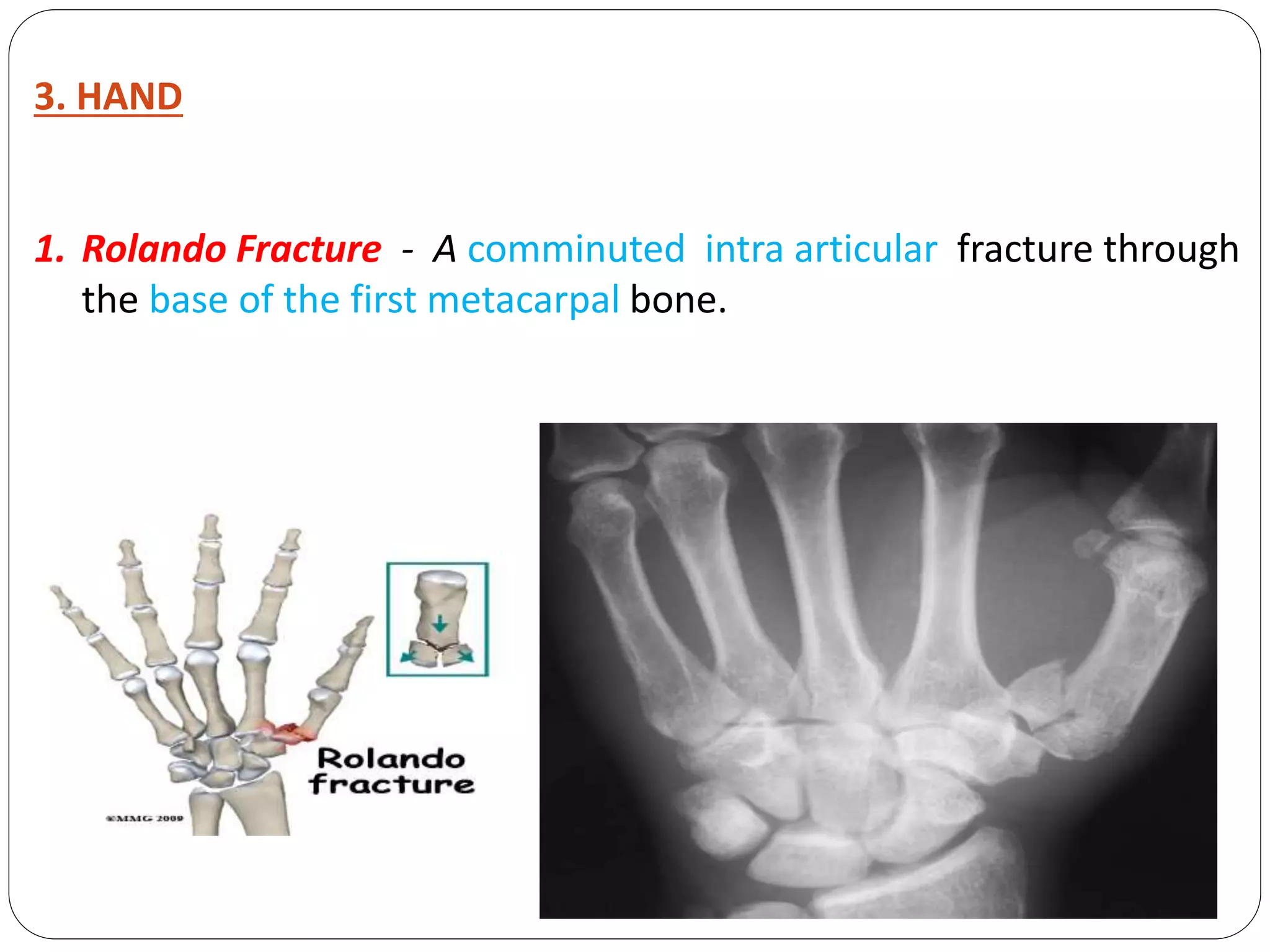 Fracture types - Plaster Of Paris tecniques and Complications | PPTX