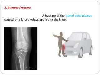 Bumper Fracture