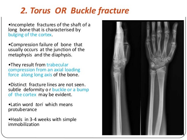 Define torus fracture - vcfeet