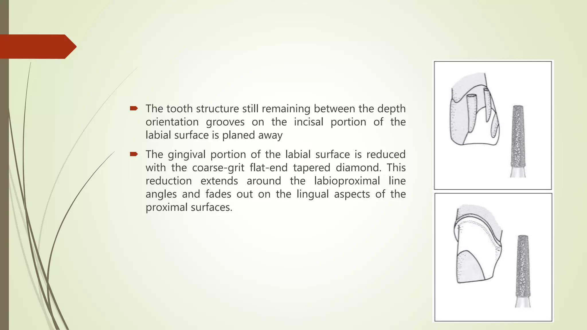 Porcelain jacket crown | PPTX