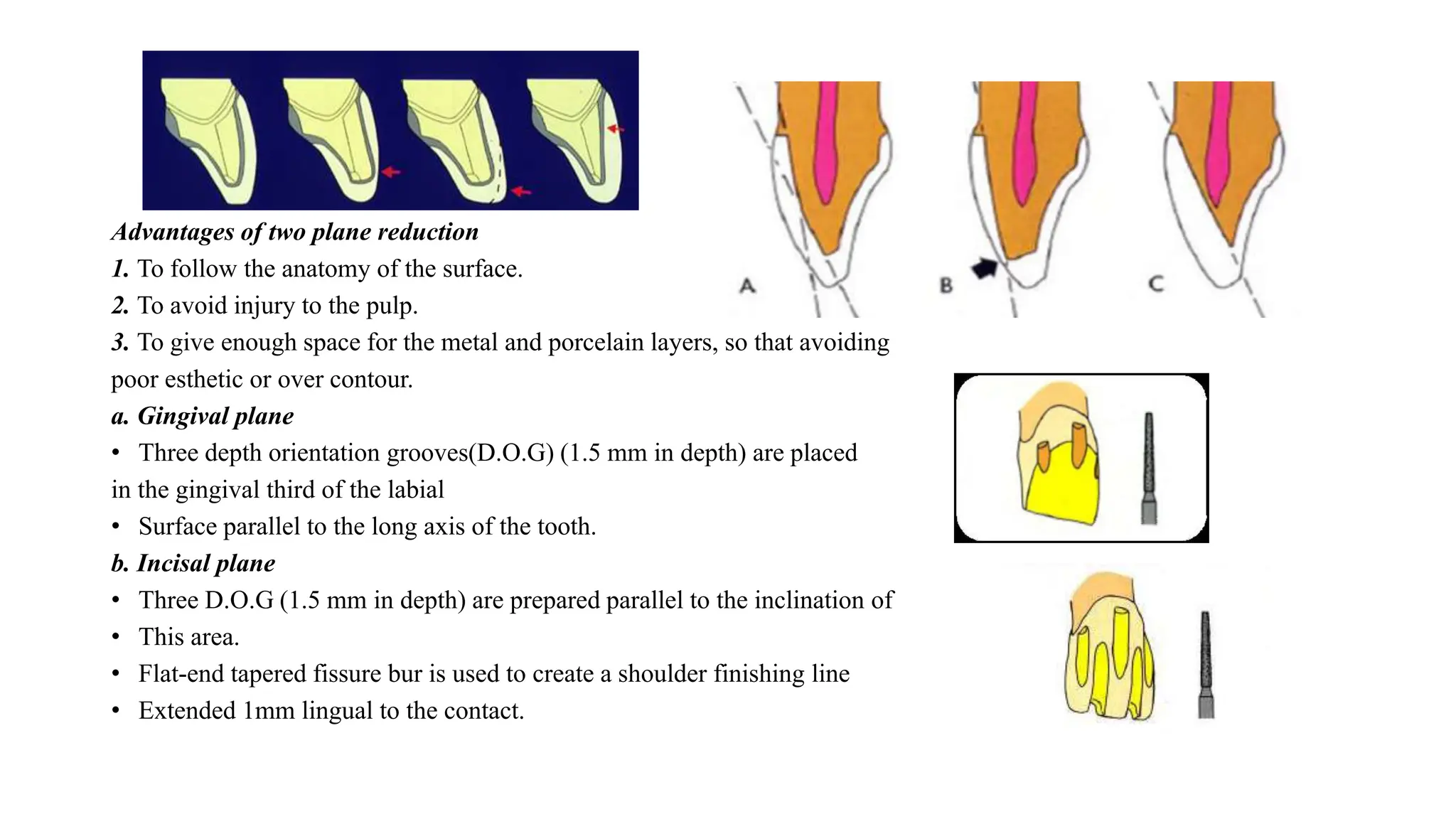 Porcelain Fused to Metal Crown in prosthodontics.pptx