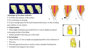Porcelain Fused to Metal Crown in prosthodontics.pptx